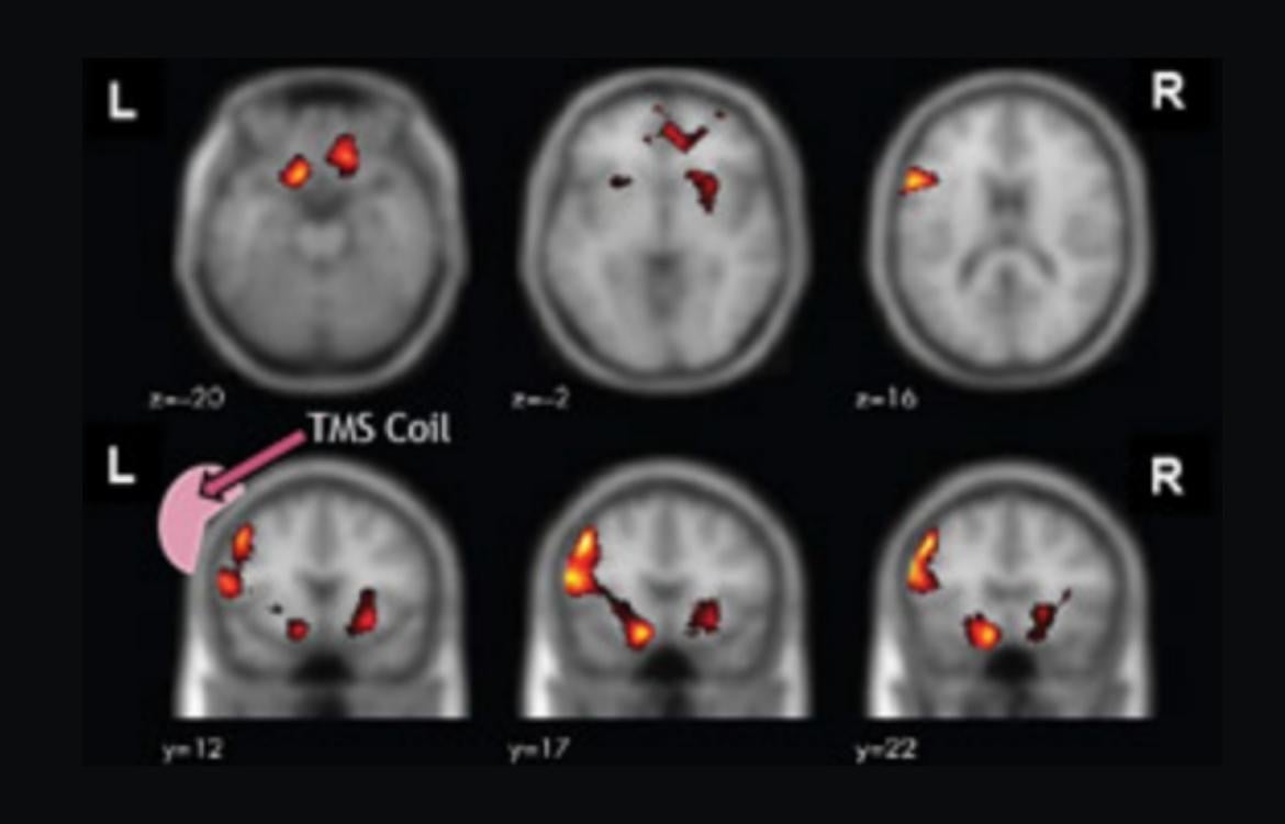 What is TMS? | neurocare group America
