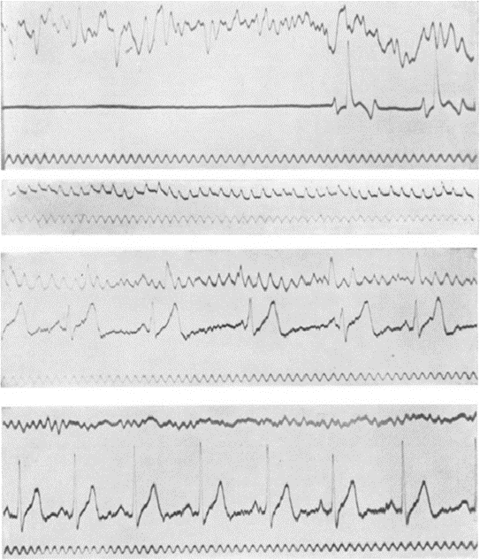 100 years of EEG: How Tracking Brain Activity Has Shaped Mental Health Care