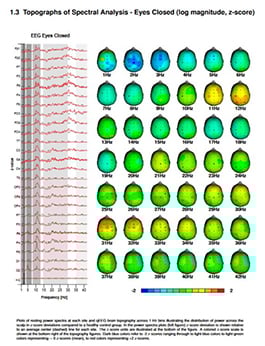 neuroLAB QEEG by neuroConn | neurocare technology