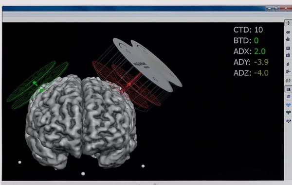 View! 3D Neuronavigation for TMS by MAG & More | neurocare technology